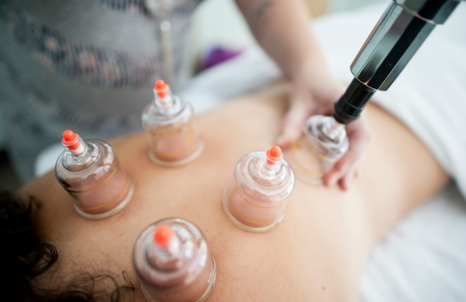 Experience Relief: Cupping Therapy Explained - Remedial Wellness